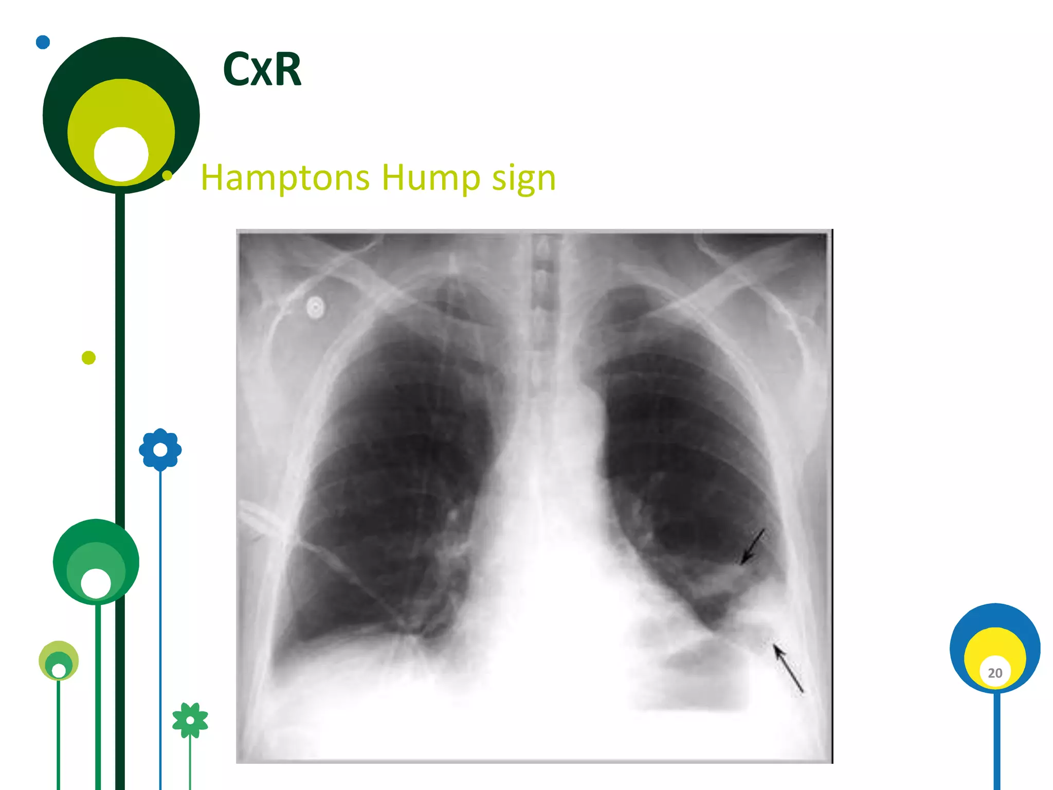 Embolic and thromboembolic diseases | PPTX