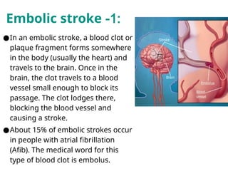 Embolic Stroke the type of ischemic .pptx