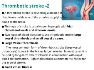 Embolic Stroke the type of ischemic .pptx