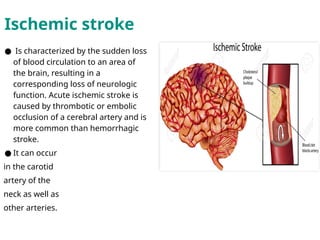 Embolic Stroke the type of ischemic .pptx