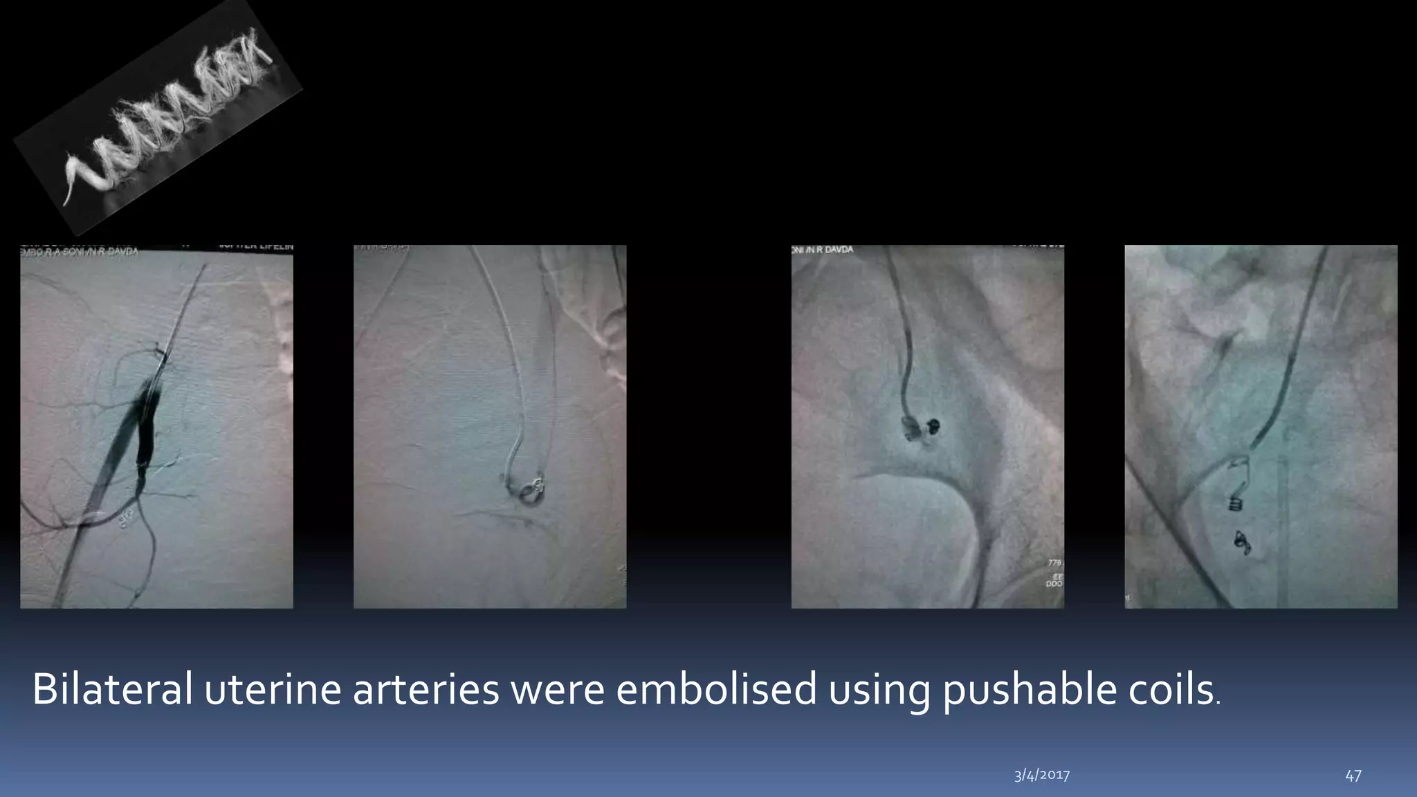 Embolising agents | PPTX