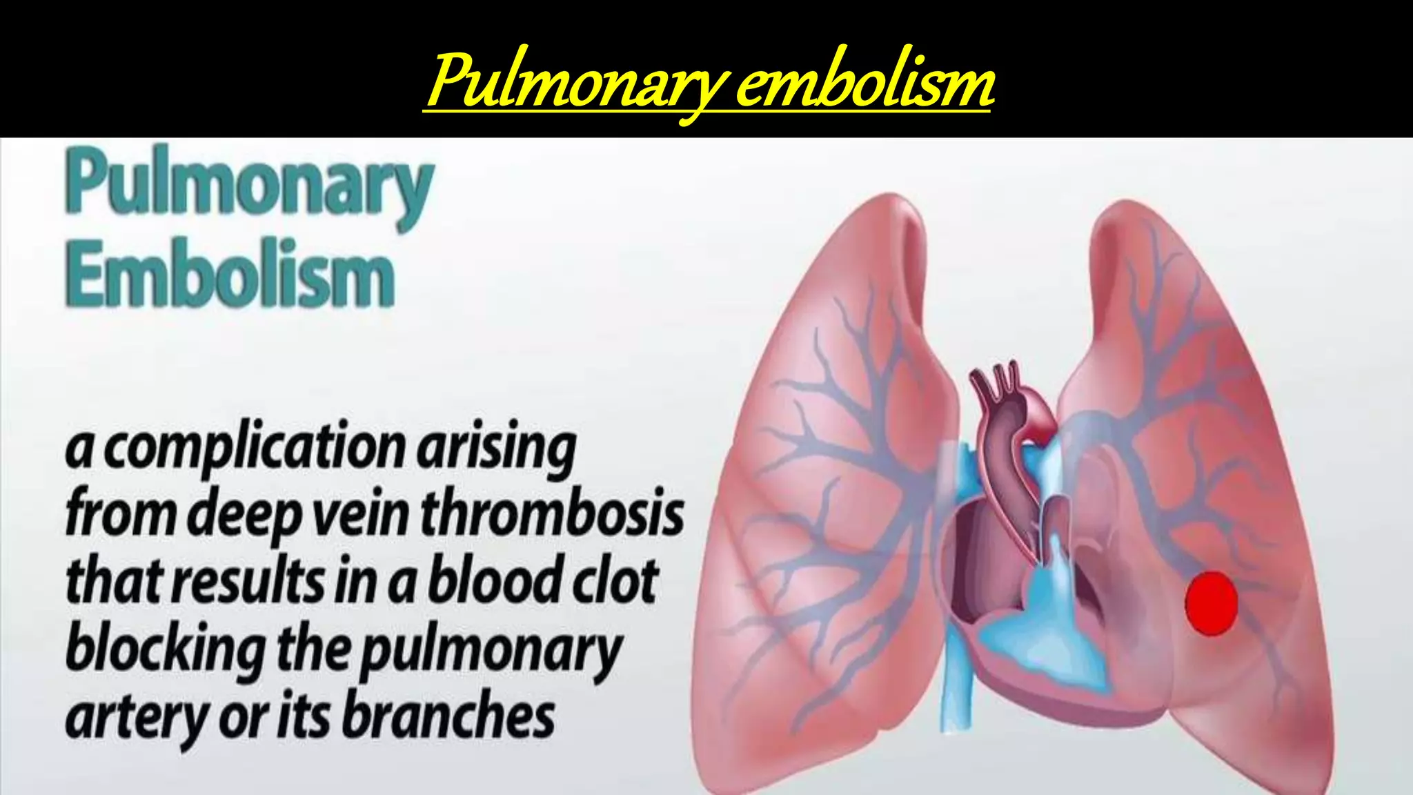 Embolism | PPTX