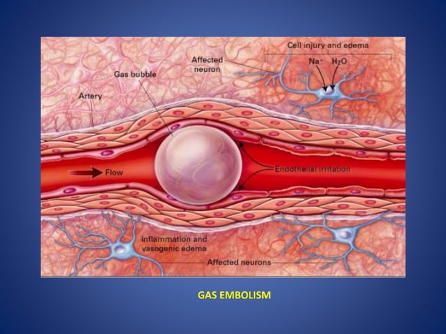 Embolism | PPSX | Lung and Respiratory Health | Diseases and Conditions