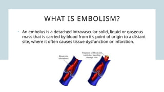 Embolism.pptx powerpoint pathology ppts | PPTX