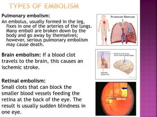 Embolism | PPTX