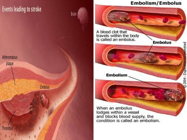 Embolism & Hemorrhage.pptx