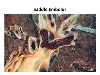 Embolism & Hemorrhage.pptx