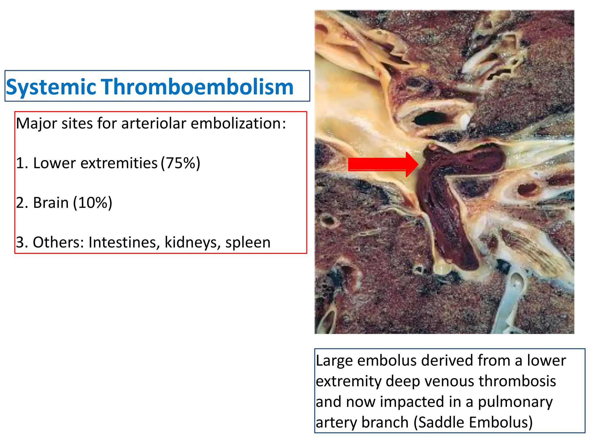 Embolism & Infarction.pdf