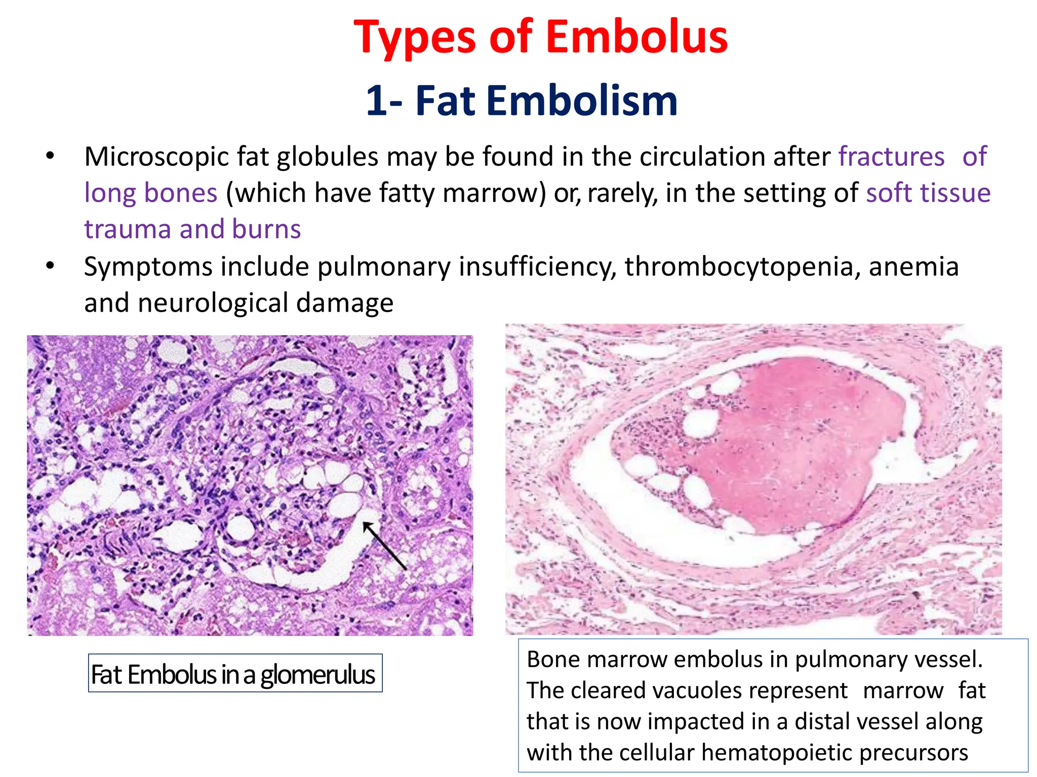 Embolism & Infarction.pdf