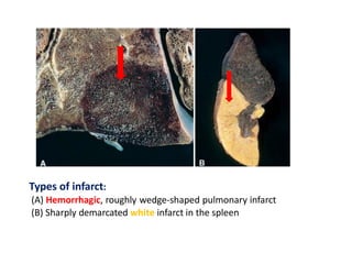 Embolism & Infarction.pdf