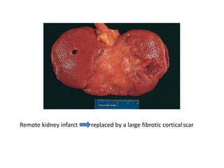 Embolism & Infarction.pdf
