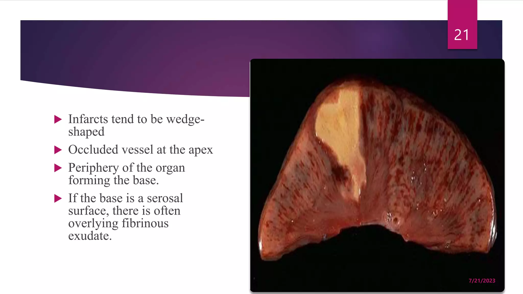 Embolism, Infarction and Shock ppt-1 slides.pptx