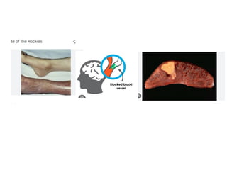 embolism, inf EMBOLISM,ISCHAEMIA AND INFARCTION.ppt