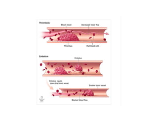 embolism, inf EMBOLISM,ISCHAEMIA AND INFARCTION.ppt