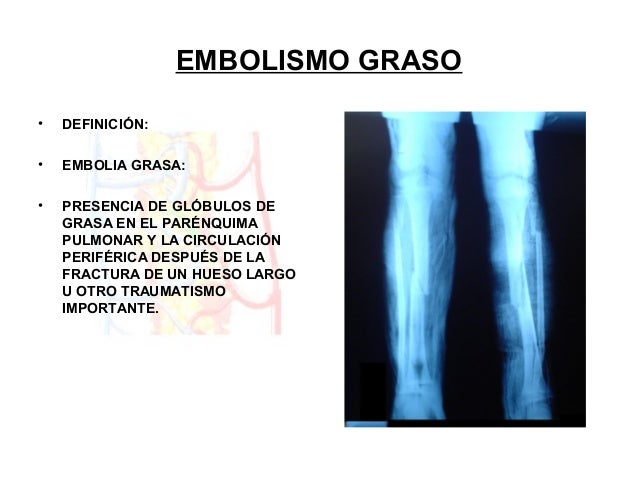 Embolismo graso (3)
