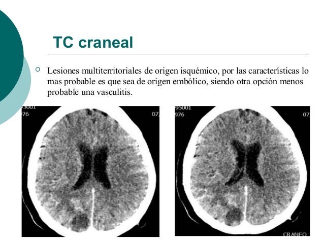Embolismos sépticos. Eva cano