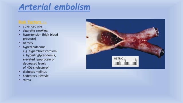 Embolisum | PPTX | Heart and Cardiovascular Diseases | Diseases and ...
