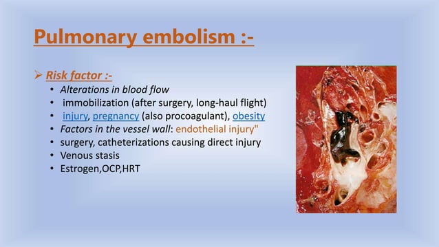Embolisum | PPTX | Heart and Cardiovascular Diseases | Diseases and ...