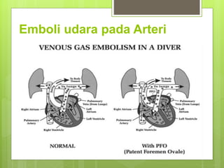 Emboli udara.pptx