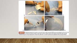 EMBOLIZATION IN JNA SURGERY. Before surgery | PPTX