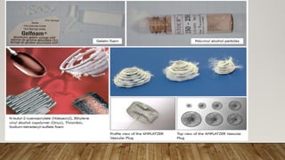 EMBOLIZATION IN JNA SURGERY. Before surgery | PPTX