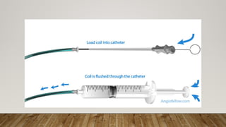 EMBOLIZATION IN JNA SURGERY. Before surgery | PPTX