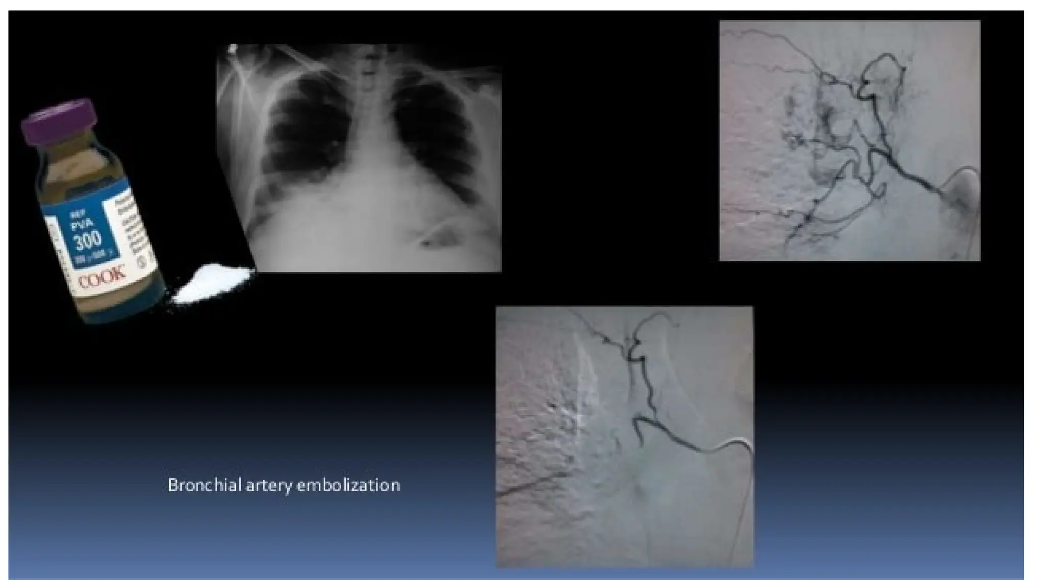 embolizing agent( Interventional Radiology).pptx