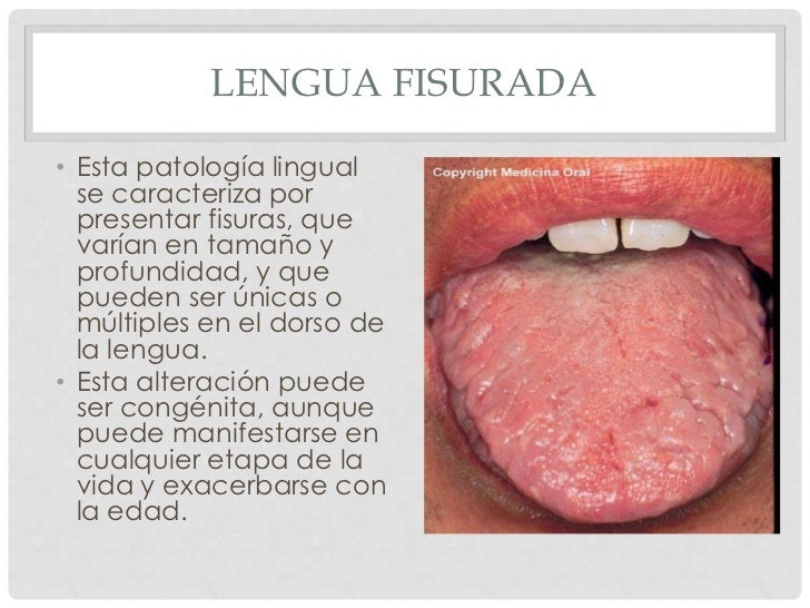 Alteraciones en cavidad oral