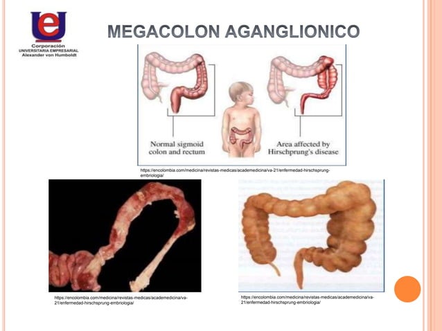 Megacolon Aganglionico/ Displasia frontonasal | PPTX