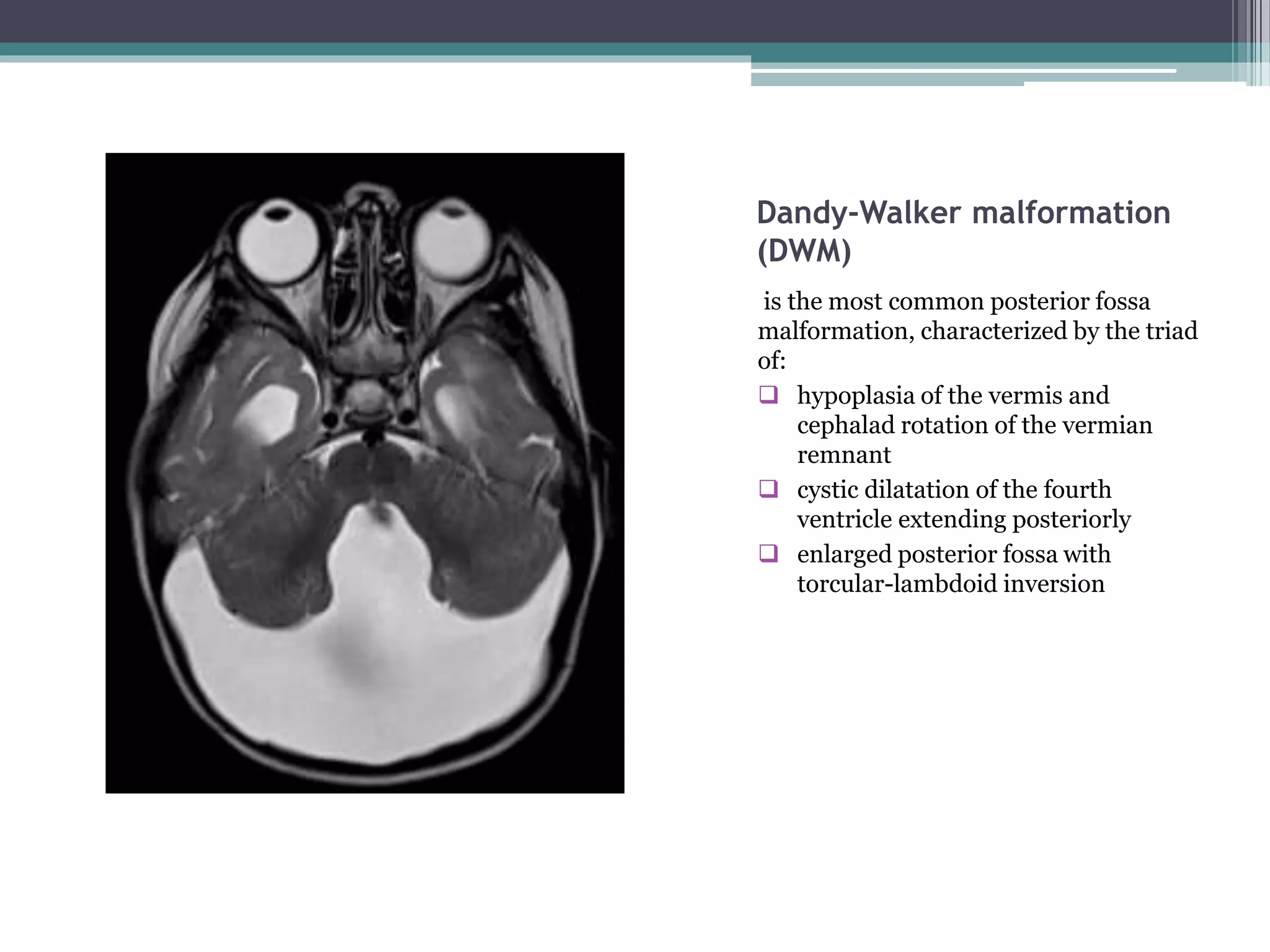 Basics of Embryology and short review of congenital errors of CNS in ...