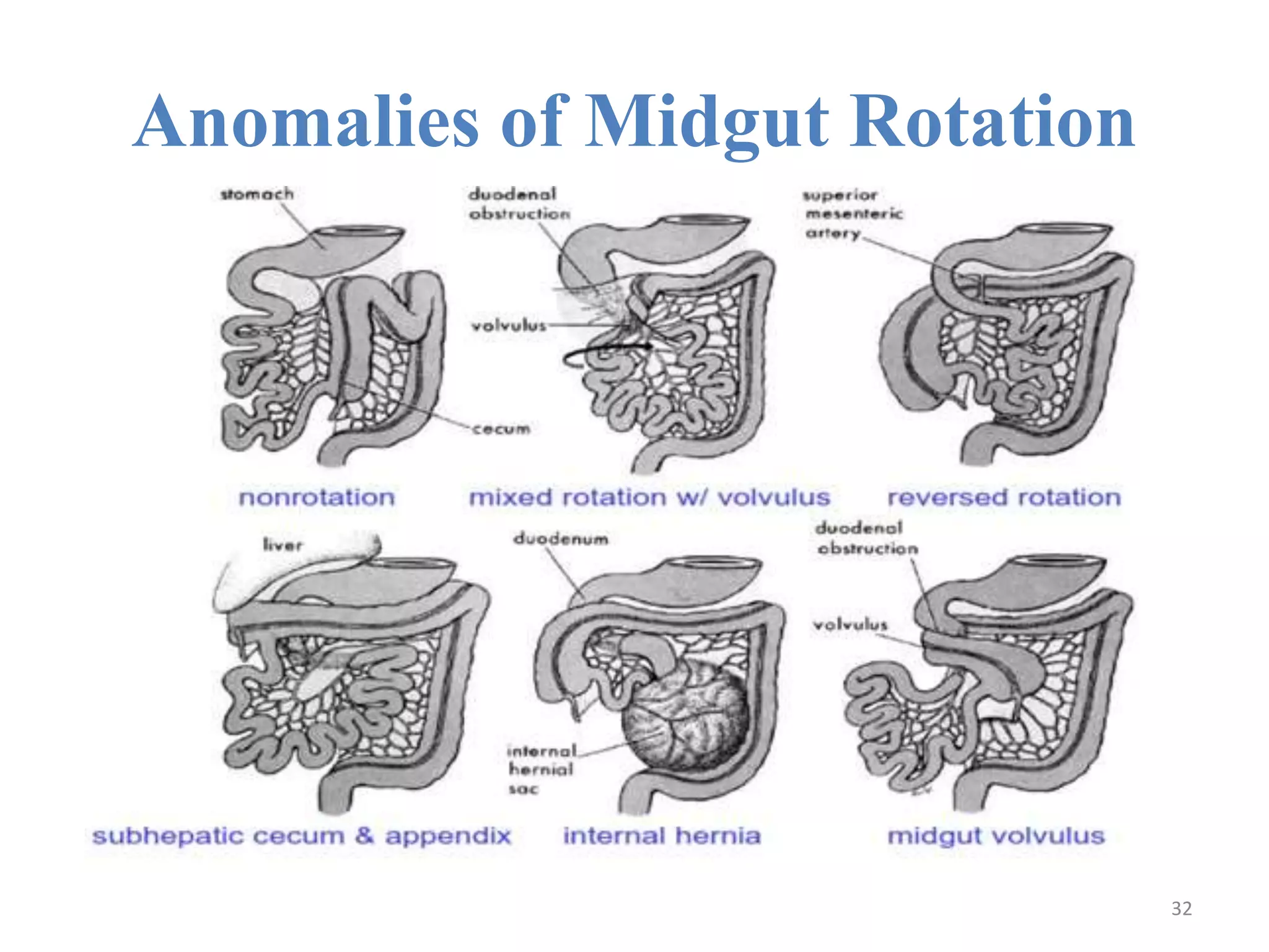 Embryologic basis of GIT malformation | PPTX