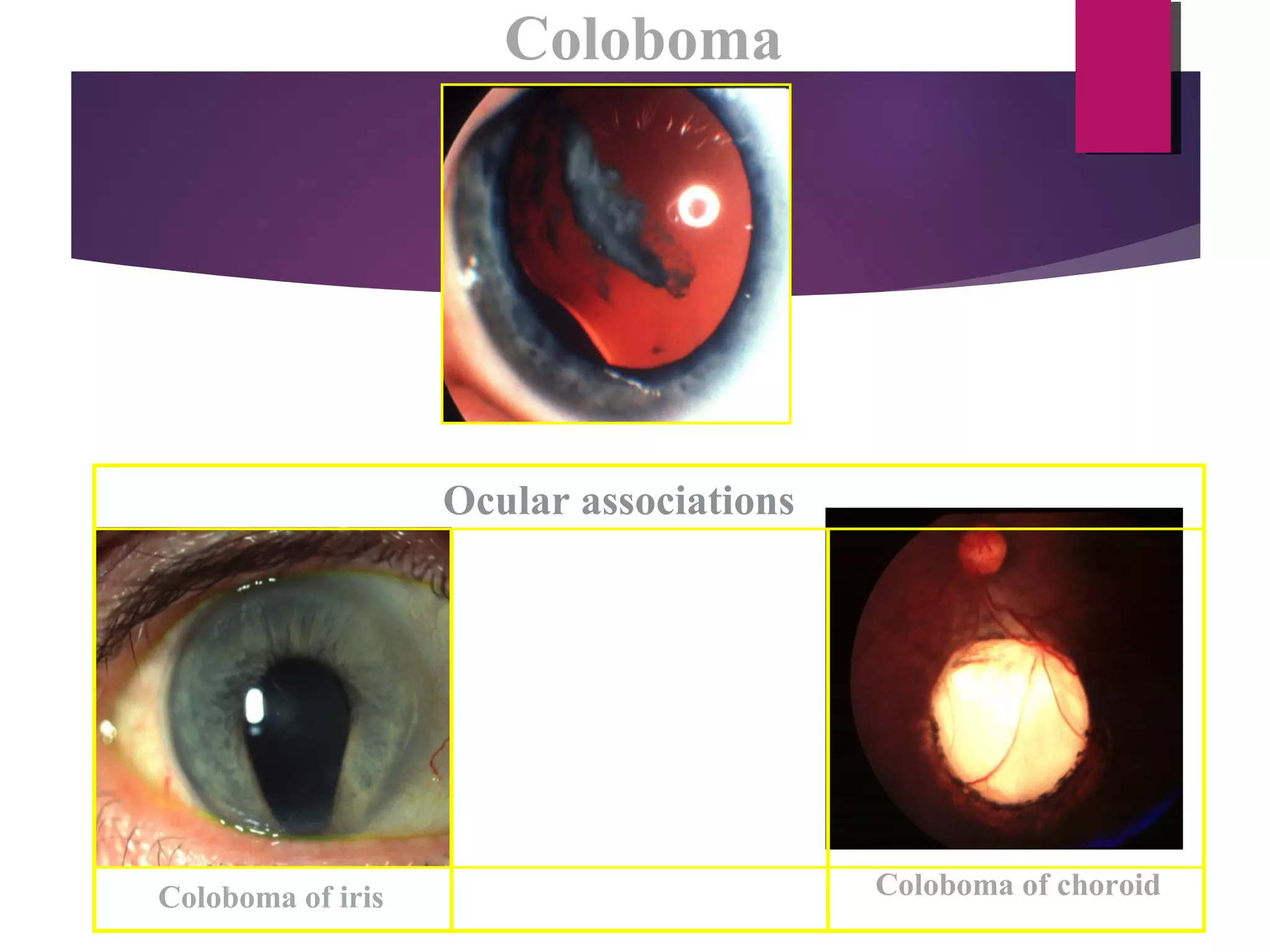 Embryology and anatomy of human lens | PPT
