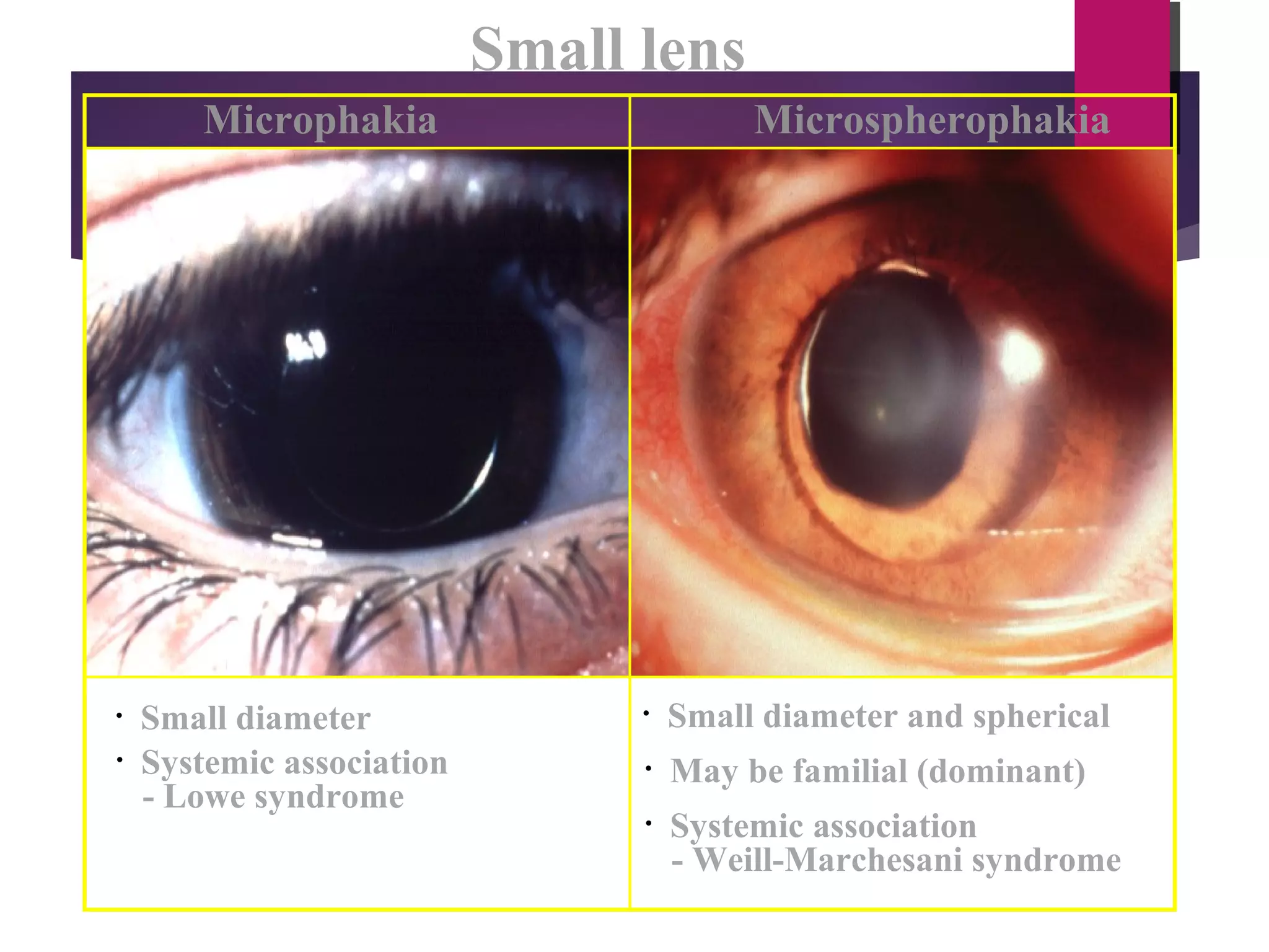 Embryology and anatomy of human lens | PPT