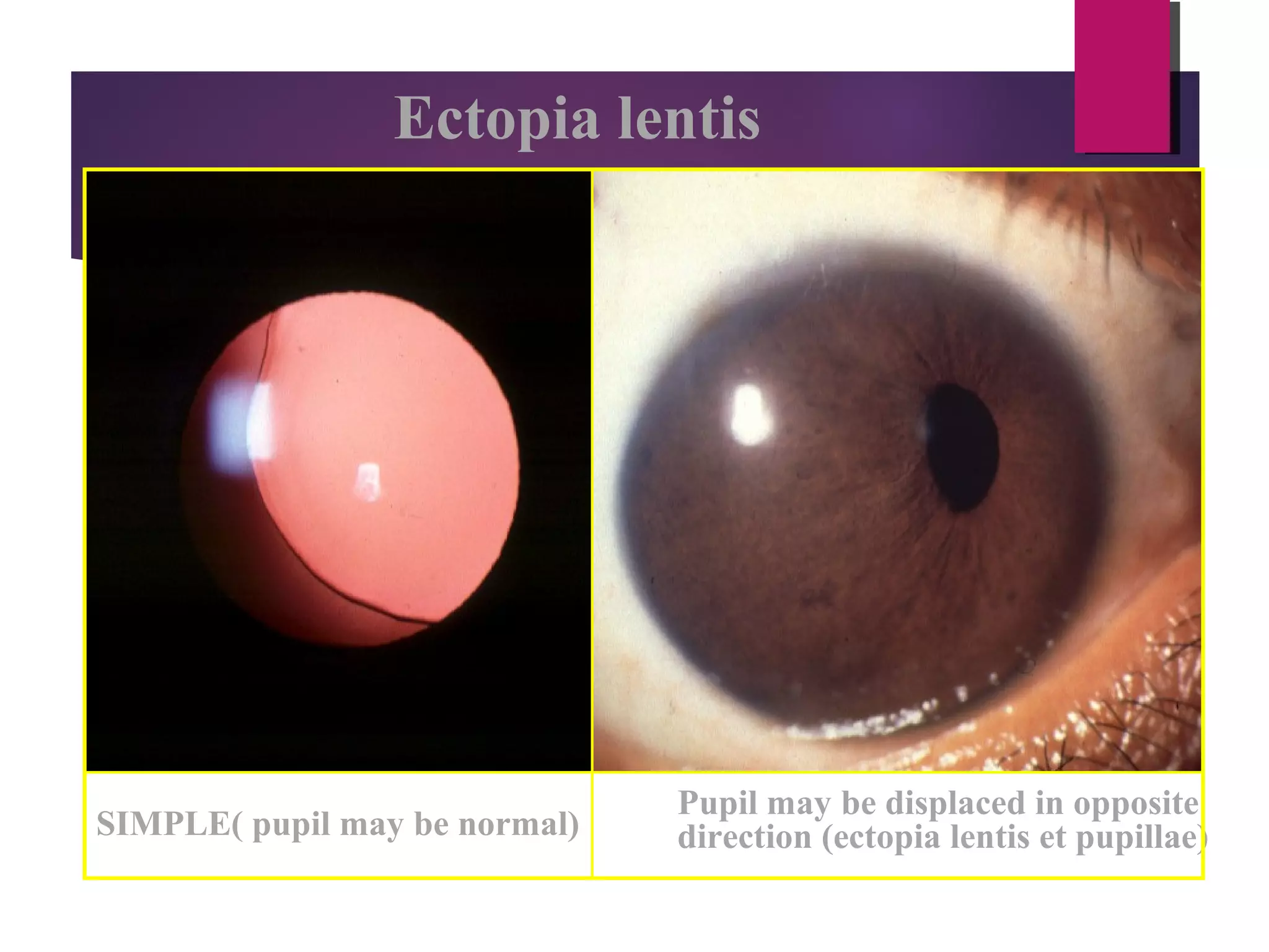 Embryology and anatomy of human lens | PPT