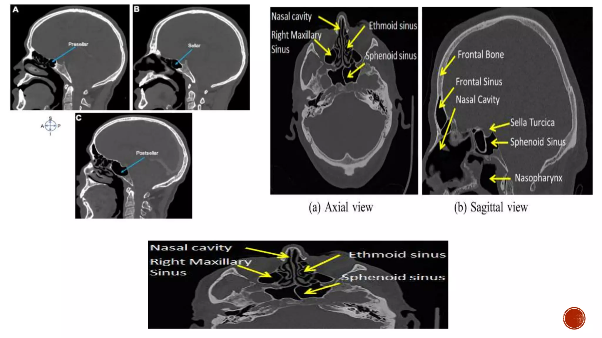 EMBRYOLOGY AND ANATOMY OF NASAL SINUSES.pptx