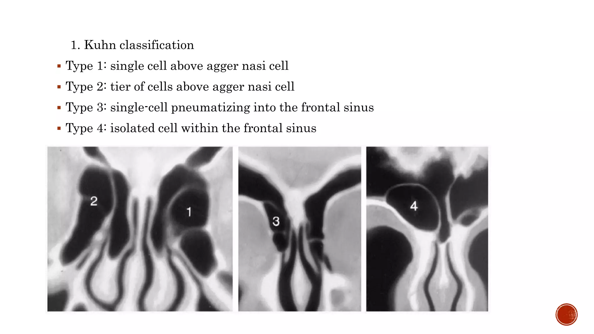 EMBRYOLOGY AND ANATOMY OF NASAL SINUSES.pptx