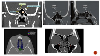 EMBRYOLOGY AND ANATOMY OF NASAL SINUSES.pptx