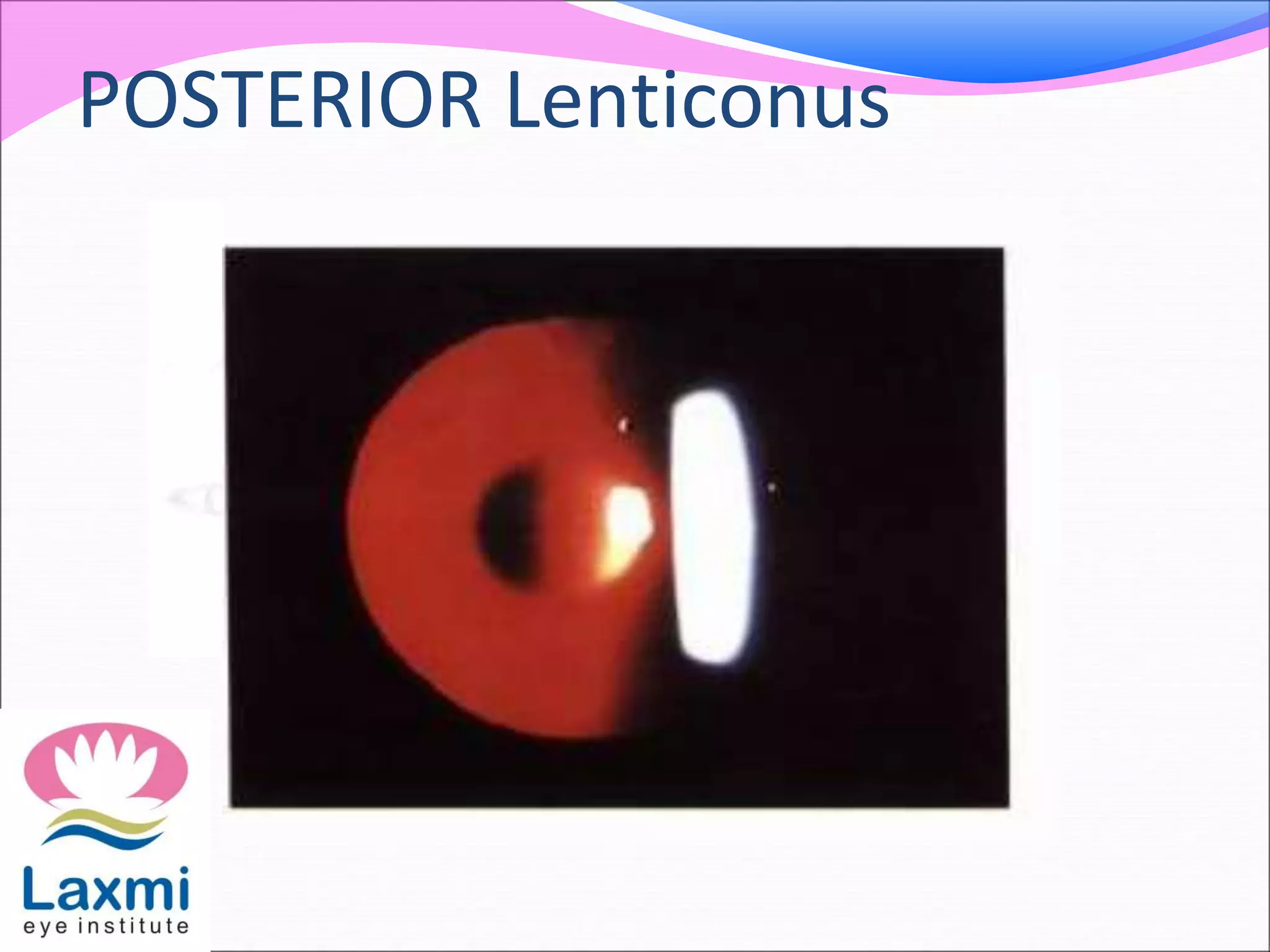 Embryology applied anatomy and physiology of lens | PPTX