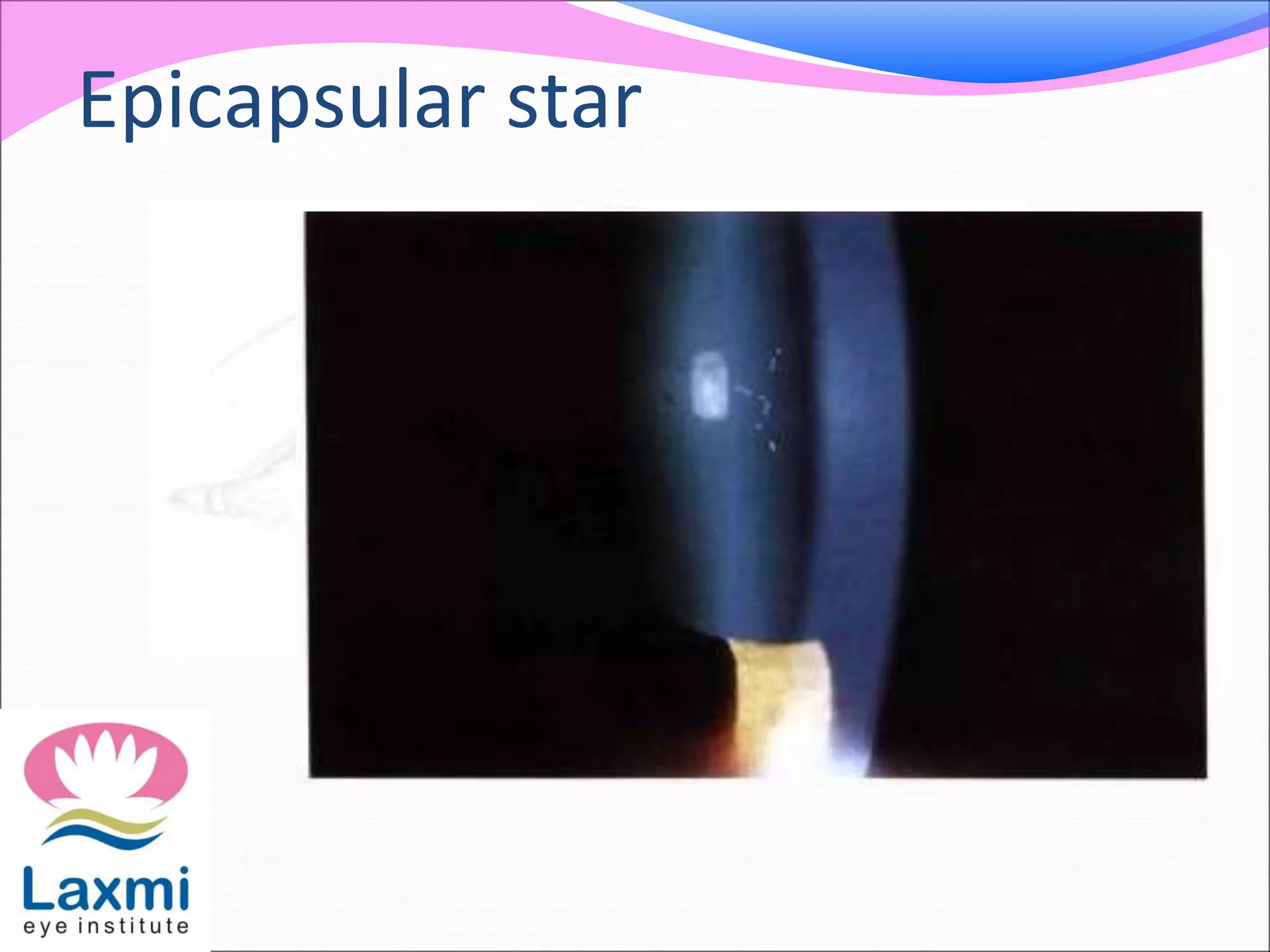 Embryology applied anatomy and physiology of lens | PPTX