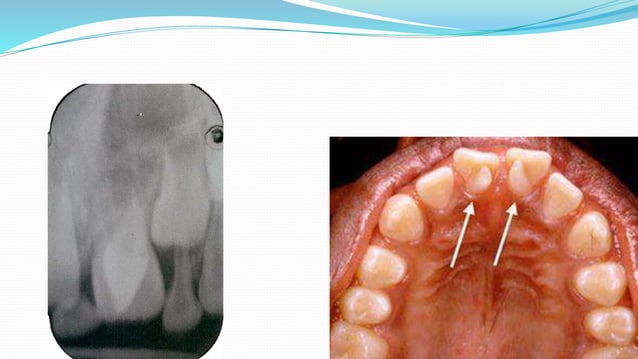 Embryology Dental and associated syndromes | PPT