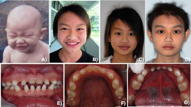 Embryology Dental and associated syndromes | PPT
