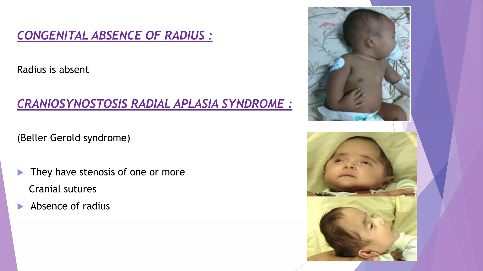 Embryology limb defects | PPTX
