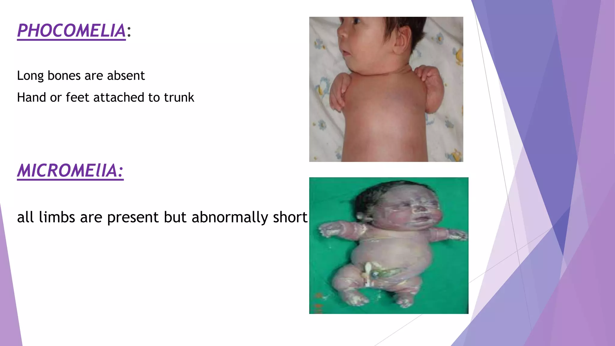 Embryology limb defects | PPTX