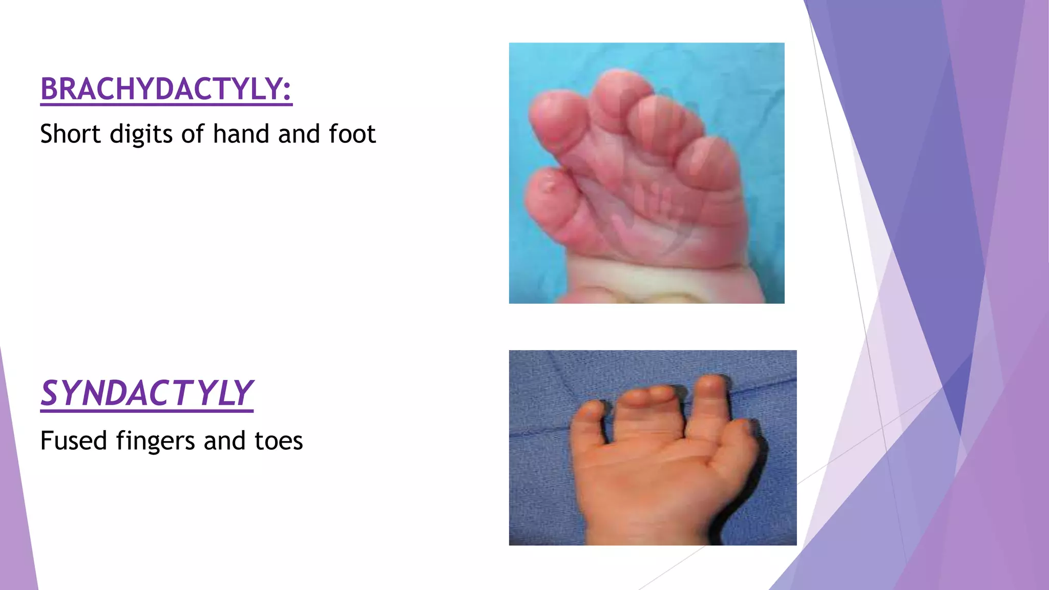 Embryology limb defects | PPTX