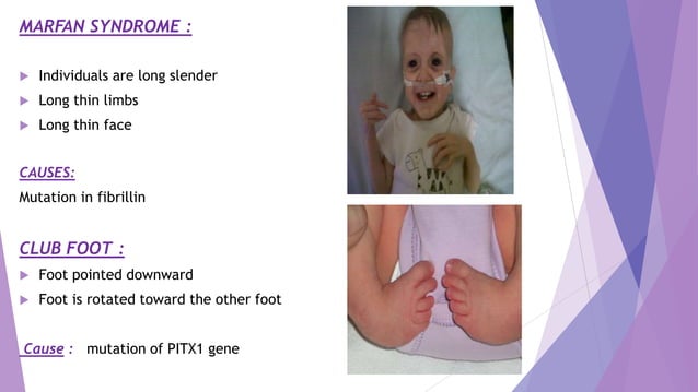 Embryology limb defects | PPTX