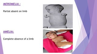 Embryology limb defects | PPTX