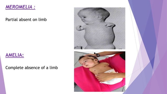 Embryology limb defects | PPTX