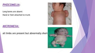 Embryology limb defects | PPTX
