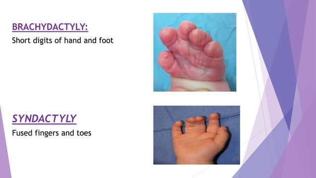 Embryology limb defects | PPTX