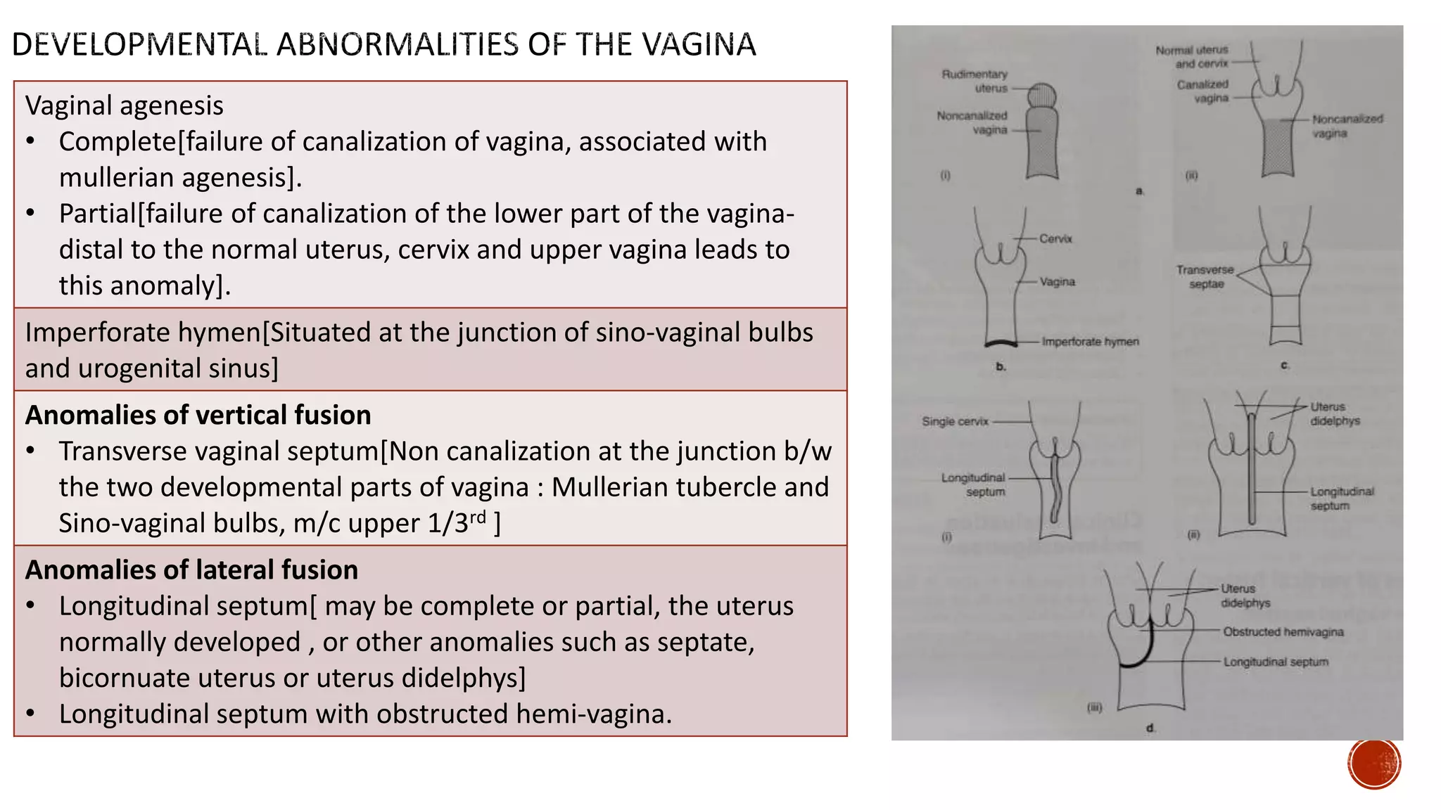 ABNORMALITIES IN DEVELOPMENT OF FEMALE GENITALIA | PPTX